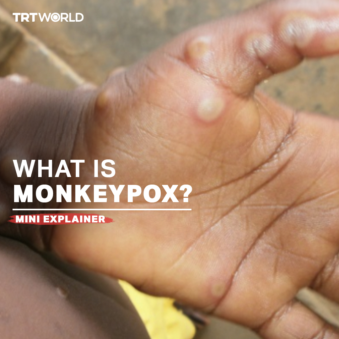 TRT World on Twitter: "The UK has been struck with a rare viral infection called ‘monkeypox ...