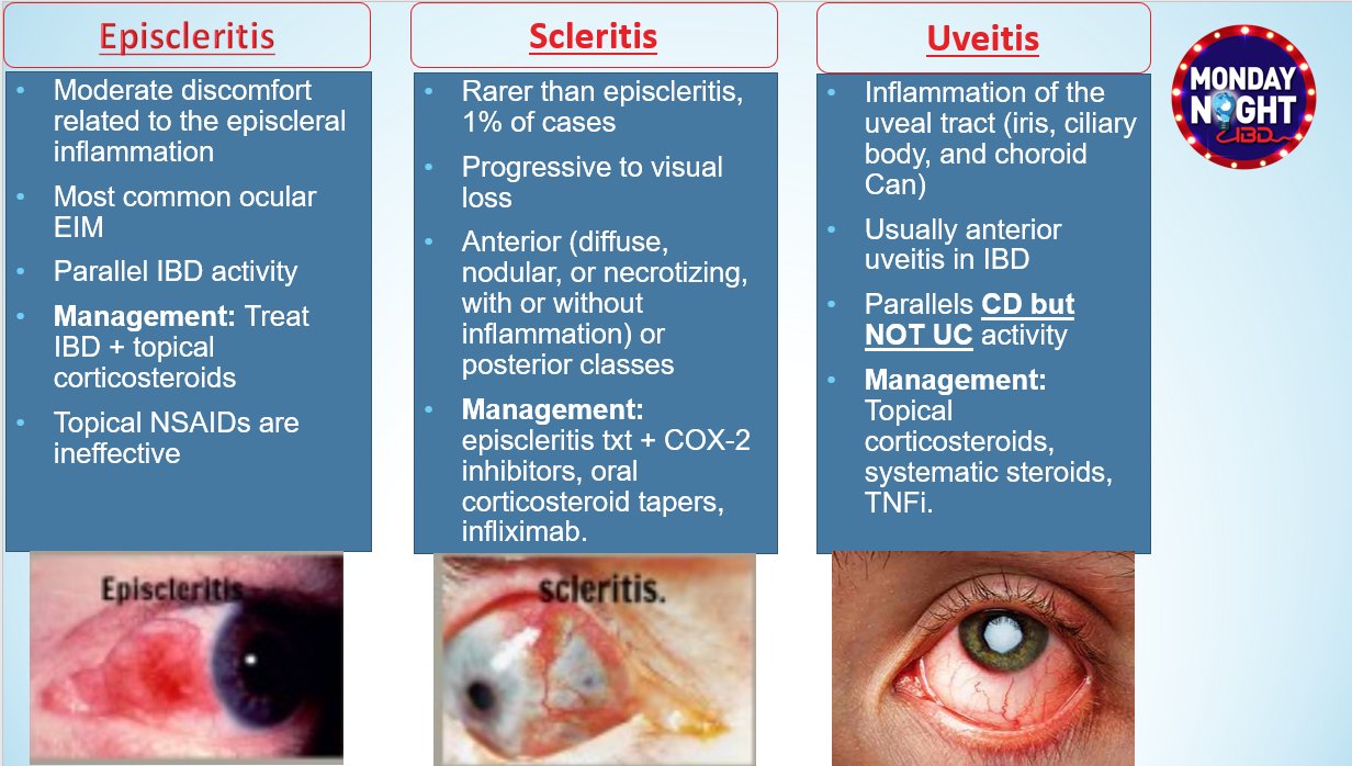 Episcleritis Vs Scleritis