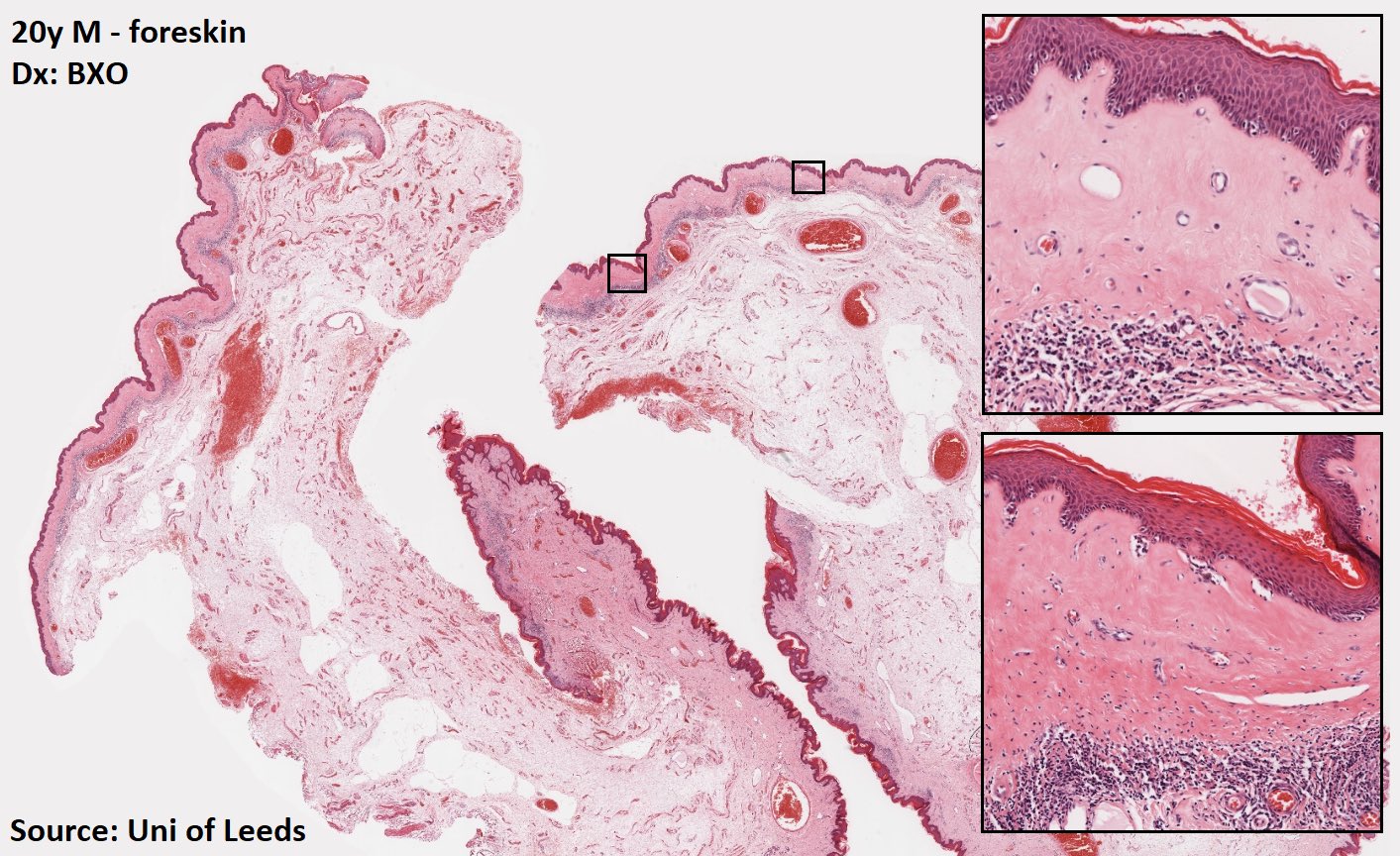 Balanitis Xerotica Obliterans Histology