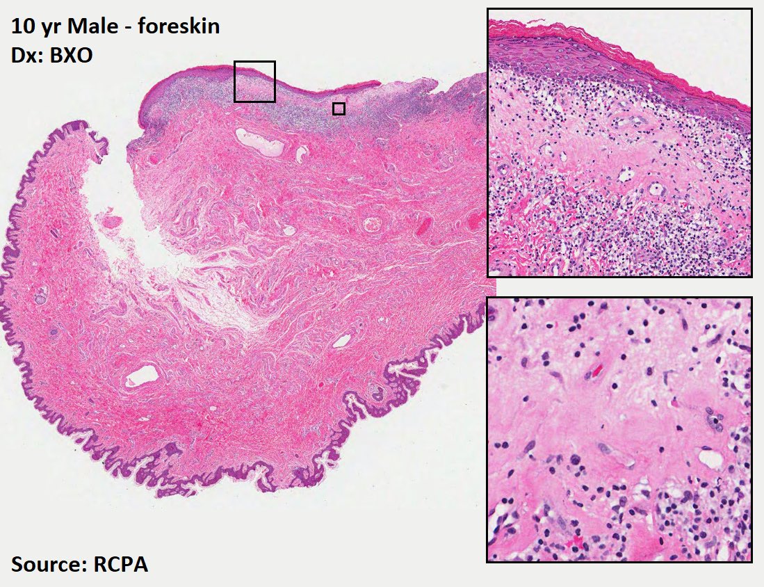 Balanitis Xerotica Obliterans Histology
