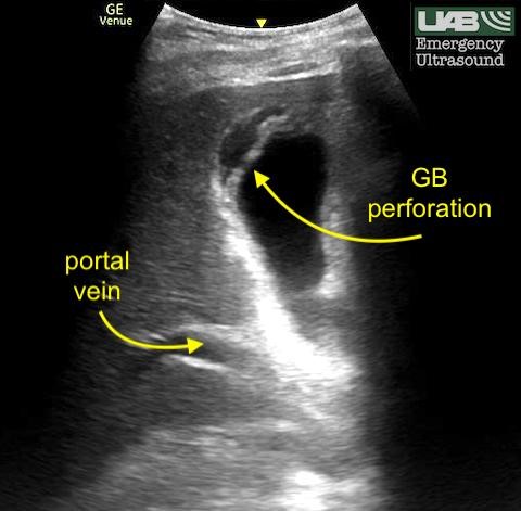 Perforated Gallbladder Ultrasound