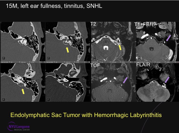 Endolymphatic Sac Mri