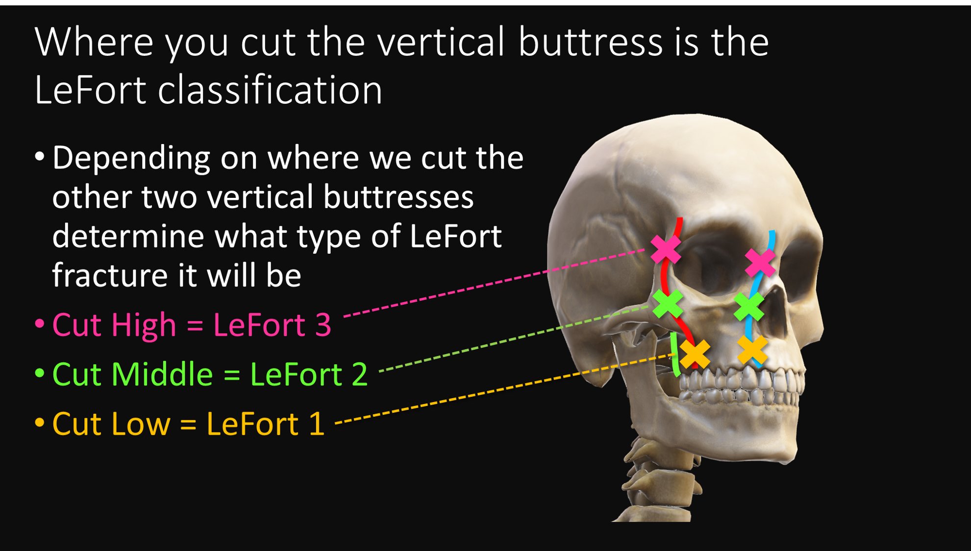 Buttressing Bone