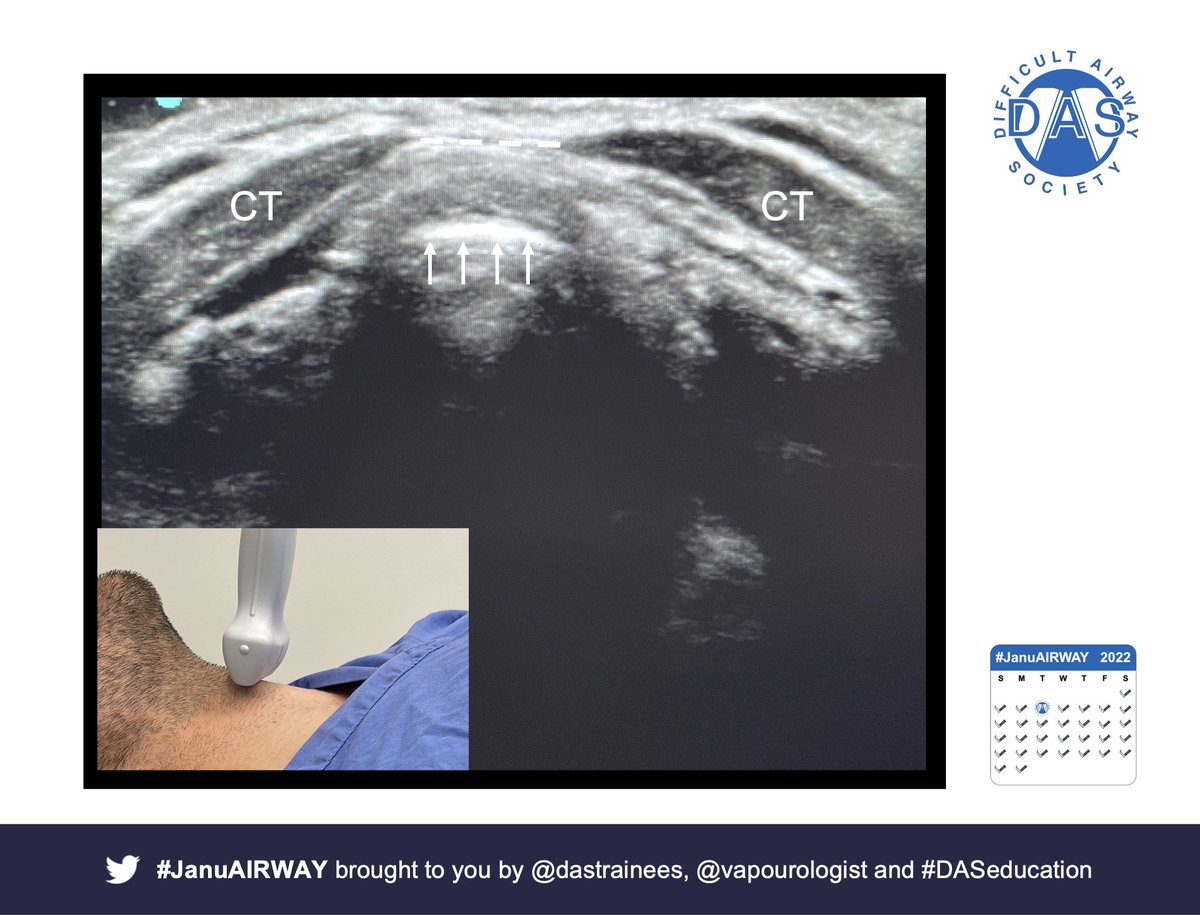 Airway Ultrasound - a 🧵 (Note: this tweetorial is stolen from # ...