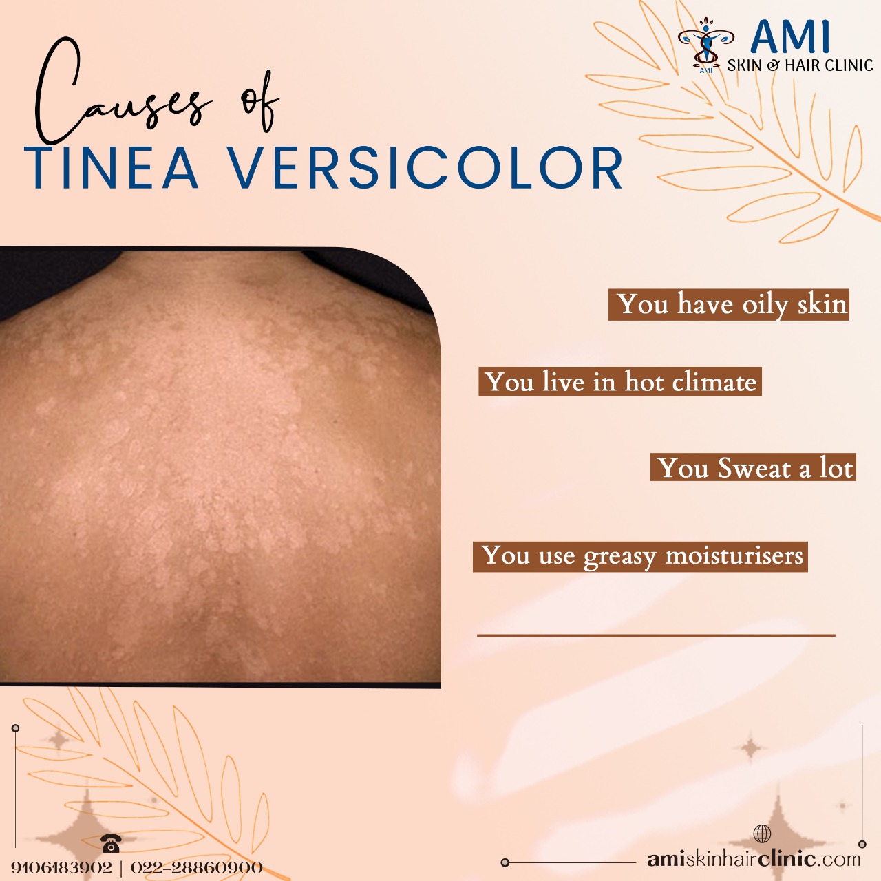 Tinea Versicolor Before And After Tinea Versicolor: Causes, Treatment