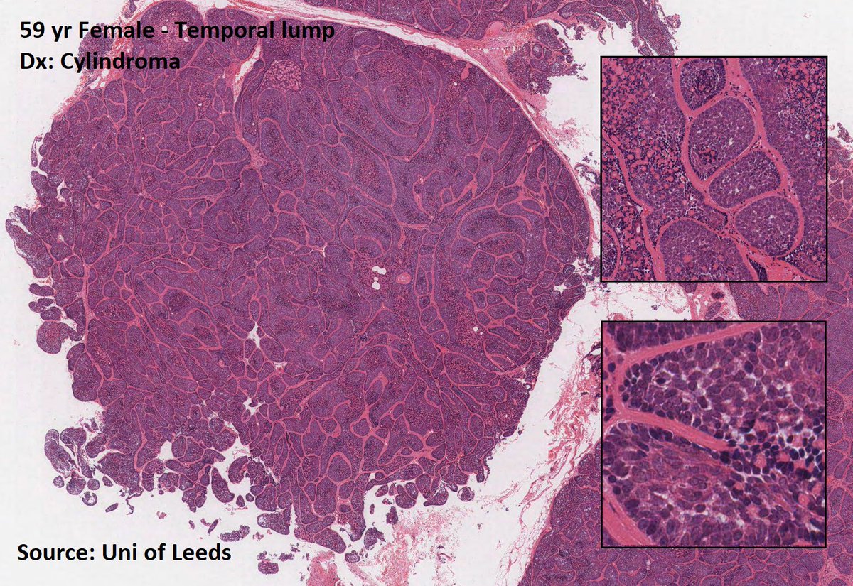 Cylindroma Histology