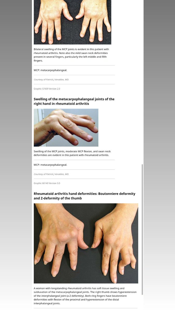 Z Deformity Duplicated Thumb And Secondary Deformity | SpringerLink