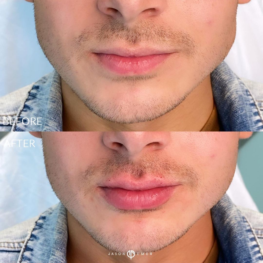Lip Shapes Men