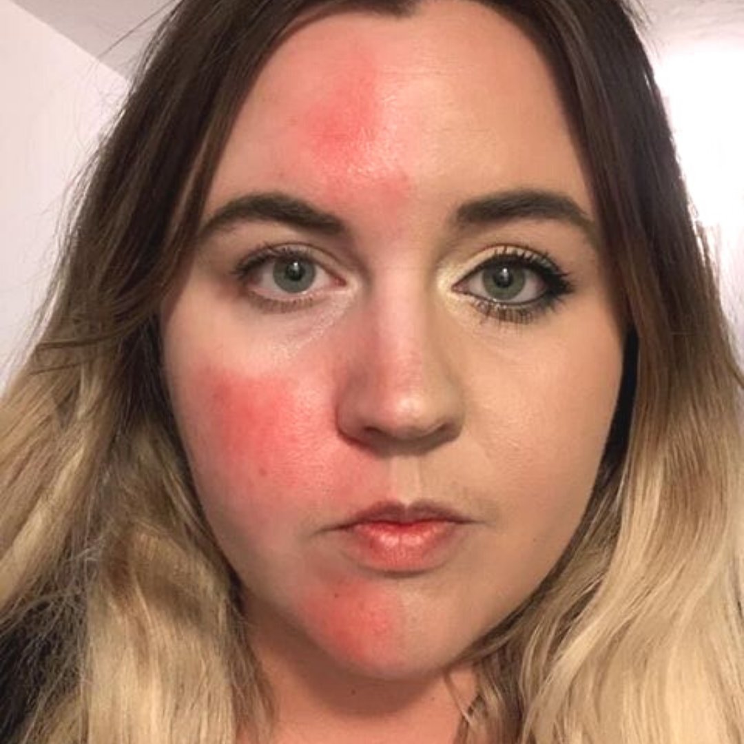 Rosacea Vs Lupus Butterfly Rash