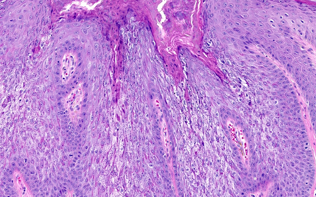 Acantholysis Histology