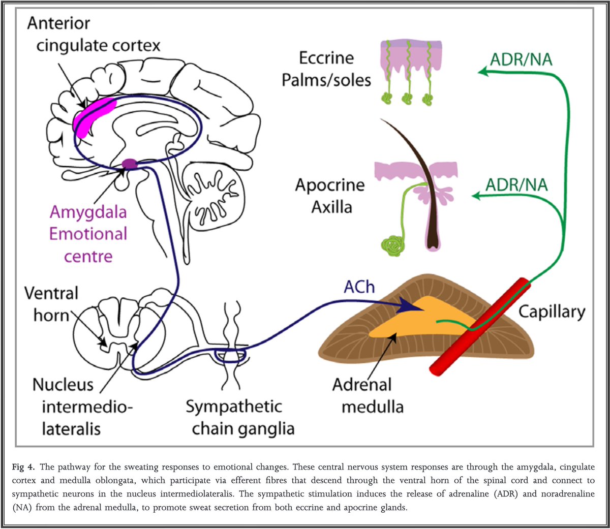 1/13 🤔 Why do patients with acute myocardial infarction often present ...