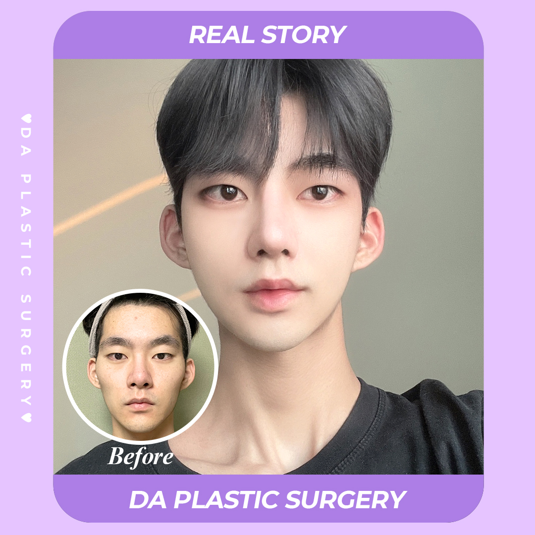 Korean Plastic Surgery Before And After Male