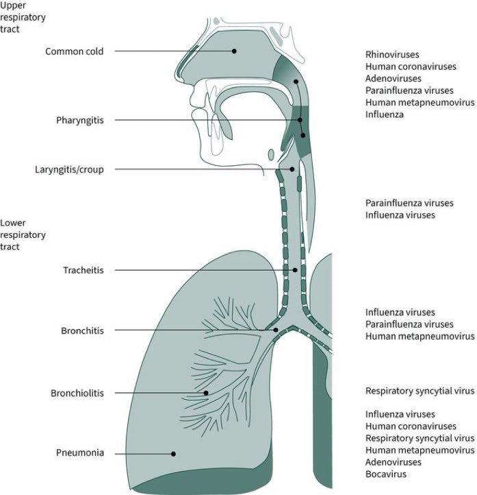 Laryngitis Diagram