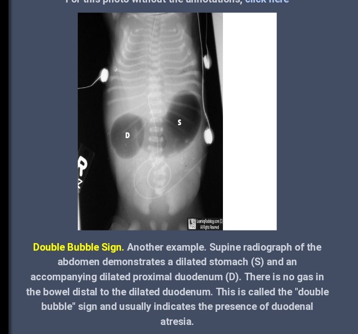 Annular Pancreas Double Bubble
