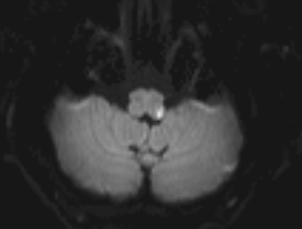 Lateral Pontine Syndrome Mri
