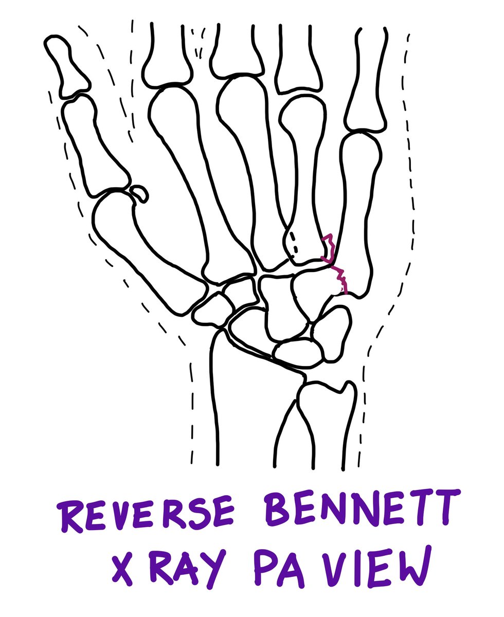 Reverse Bennett Fracture