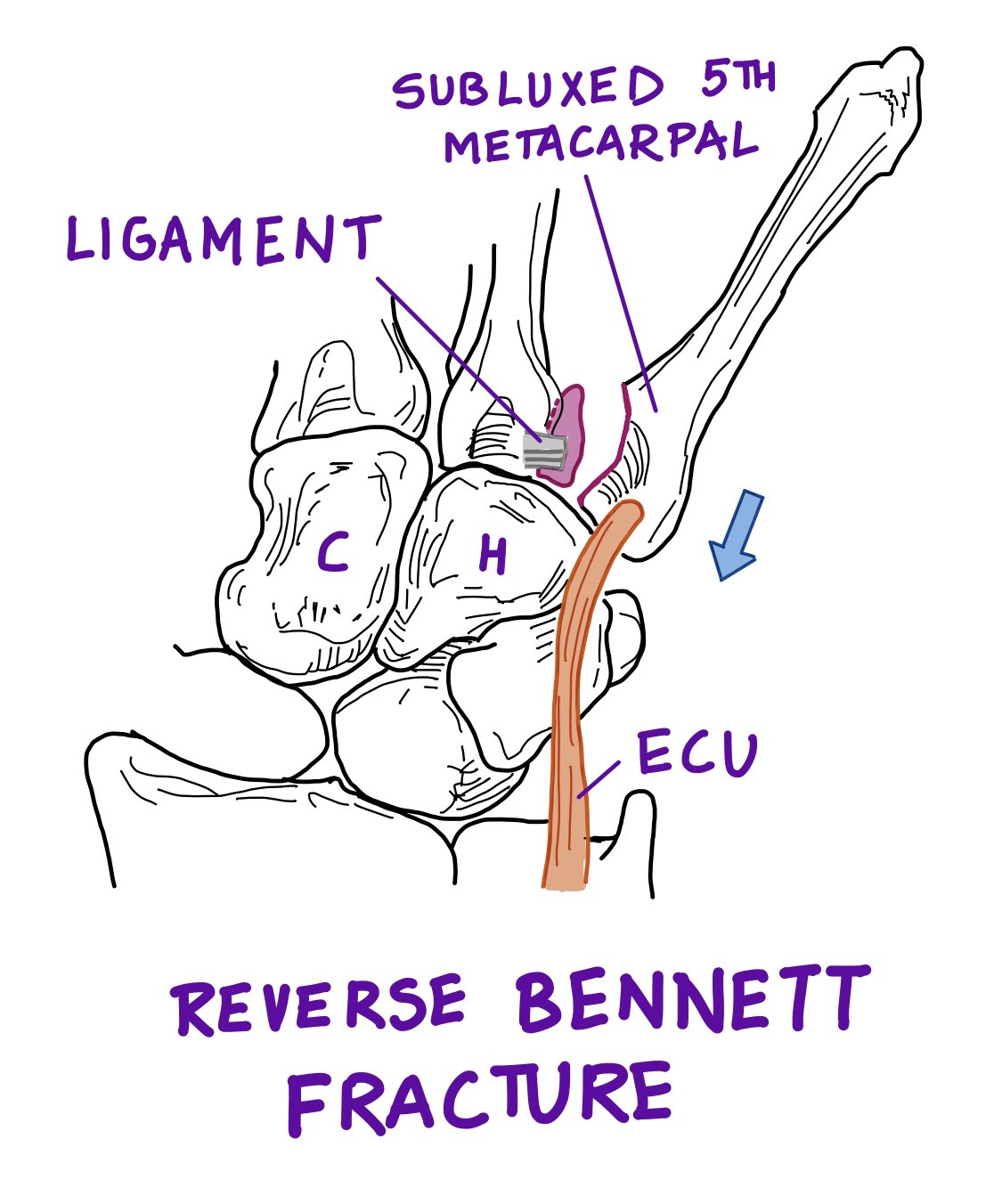 Reverse Bennett Fracture
