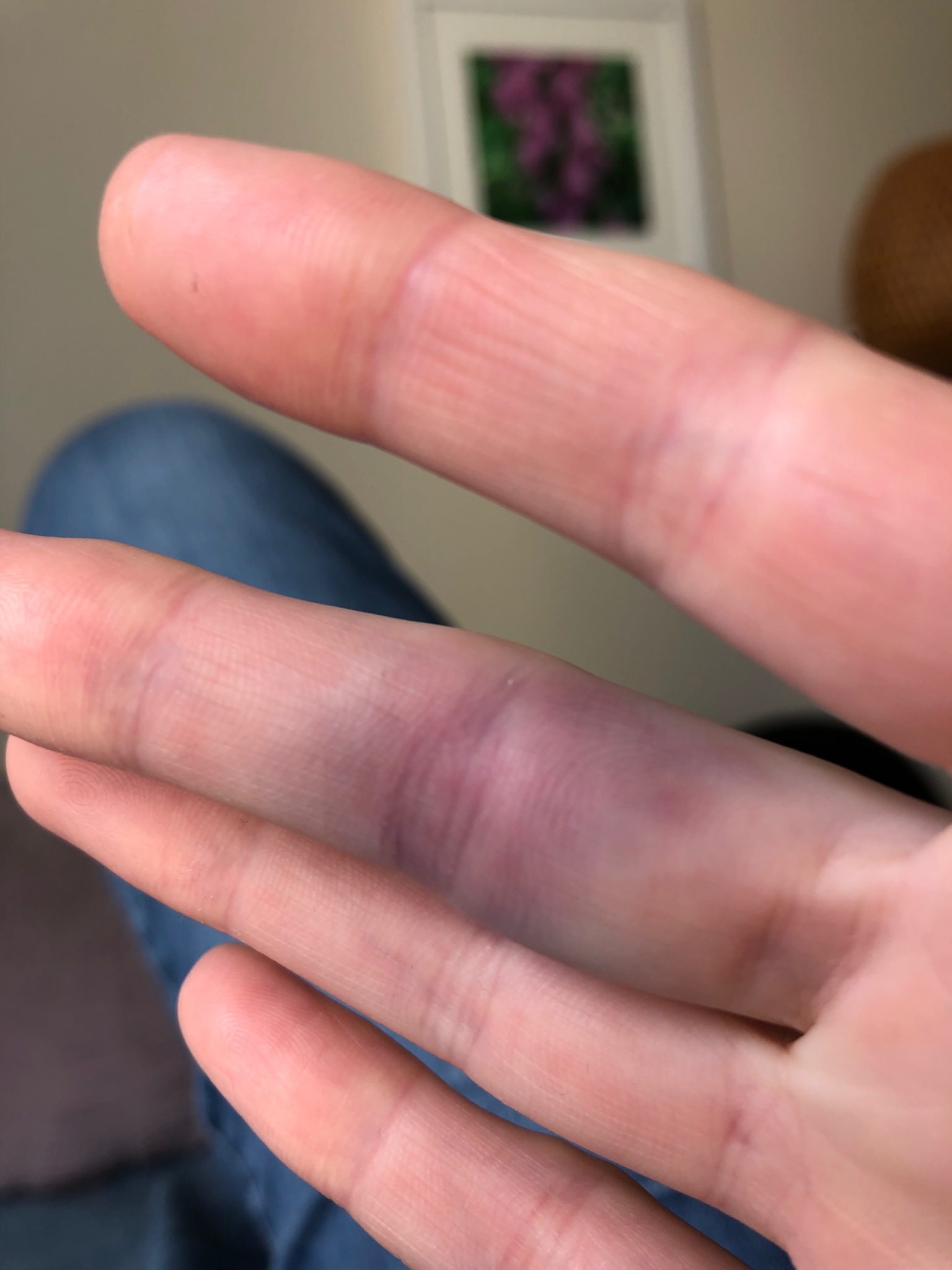 Burst Blood Vessel In Finger Images Blood Blisters: Causes, Diagnosis,