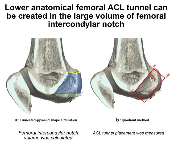 Intercondylar Notch