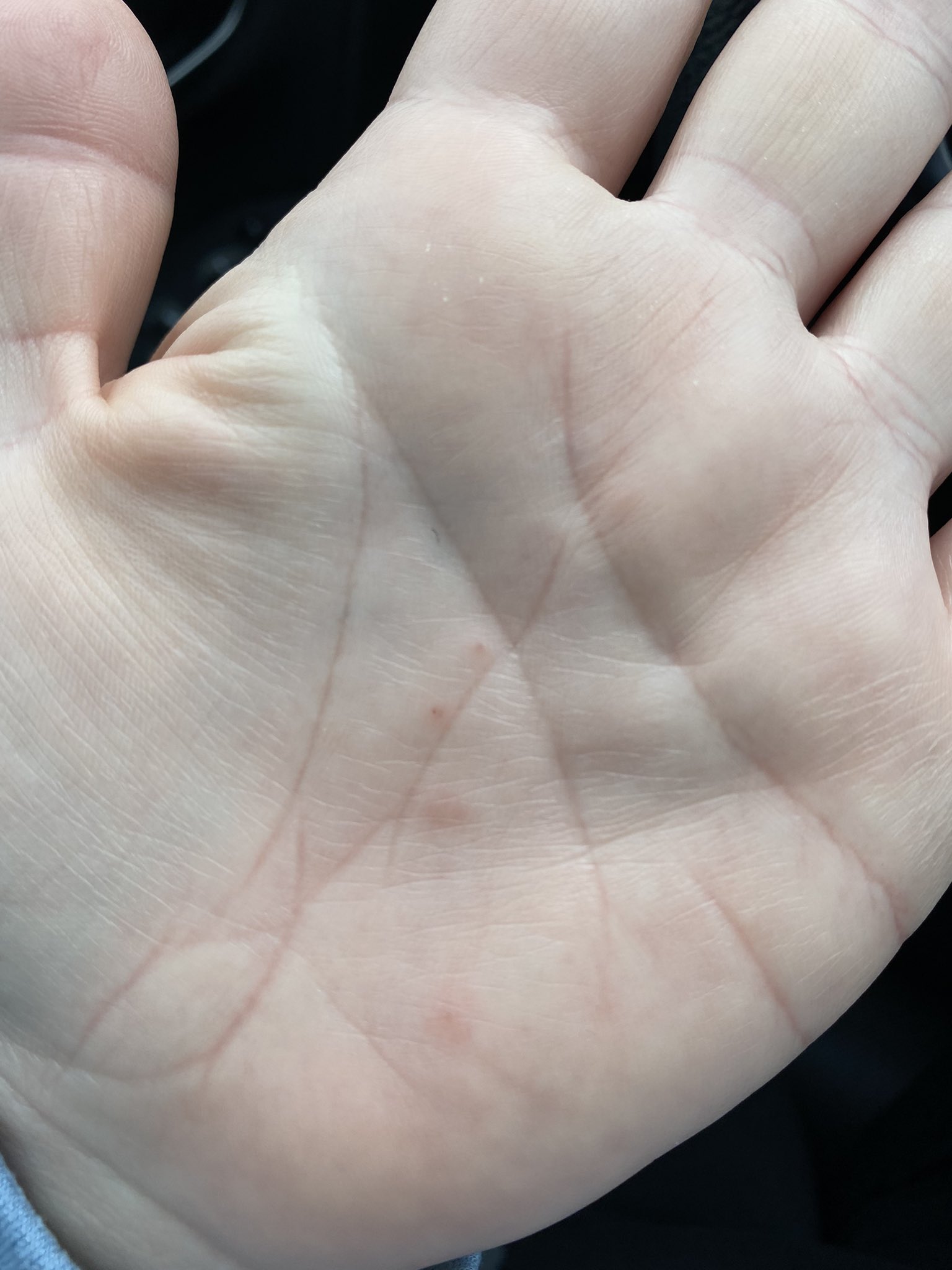 Bumps On Palms Of Hands bumps-on-palms-of-hands