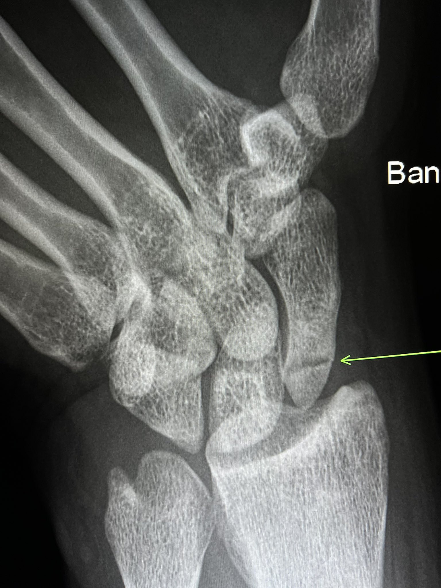 Ulnar Deviation X Ray Radiographic Imaging Of Scaphoid Frx : Wheeless'