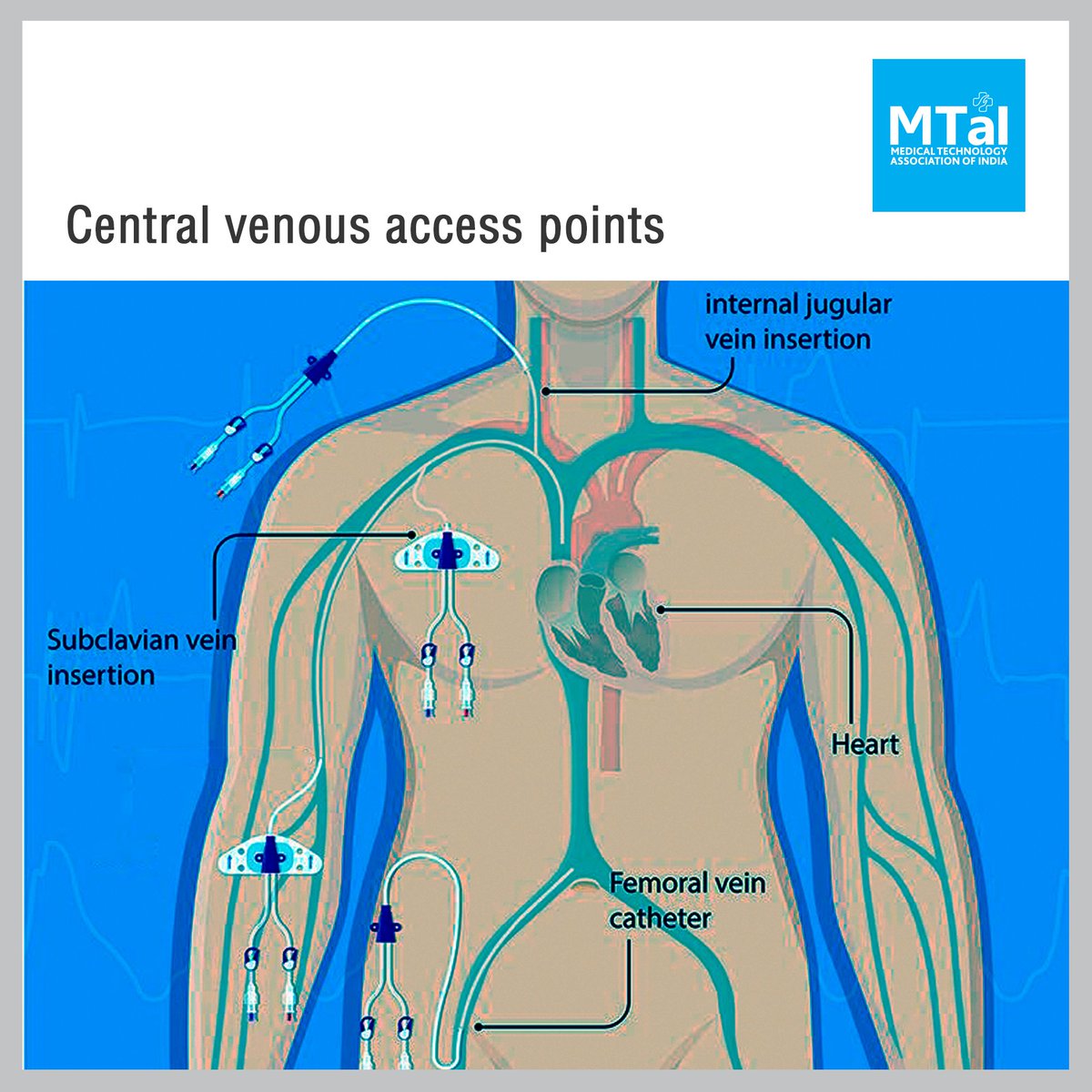 Central Line Catheter Jugular