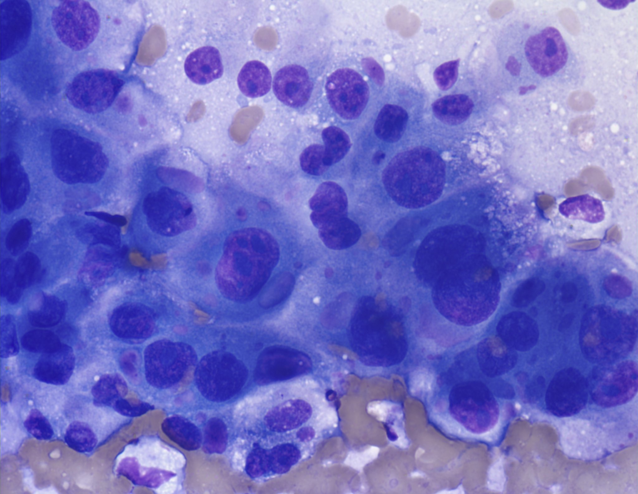 Hepatocellular Carcinoma Cytology