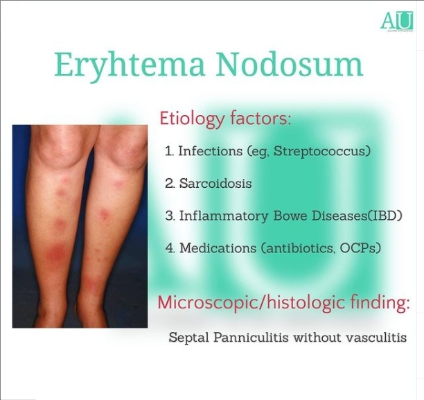 Erythema Nodosum Sarcoidosis