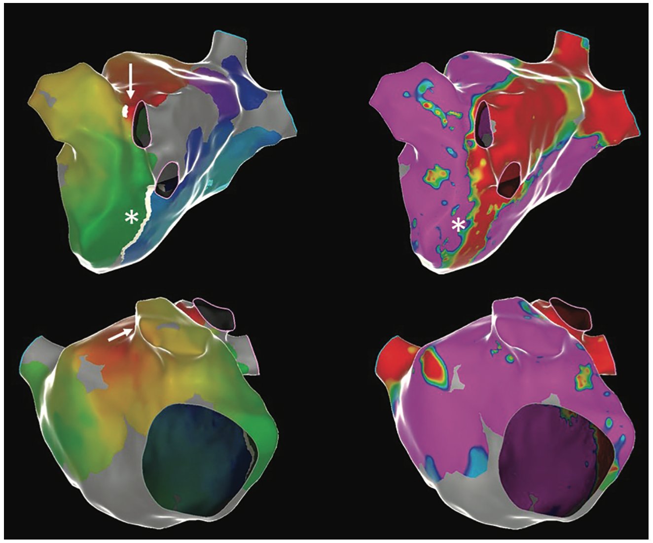 EP Lab Digest on Twitter: "Hey #EPeeps! Be sure to check out this review now on EPLD: Ablation ...