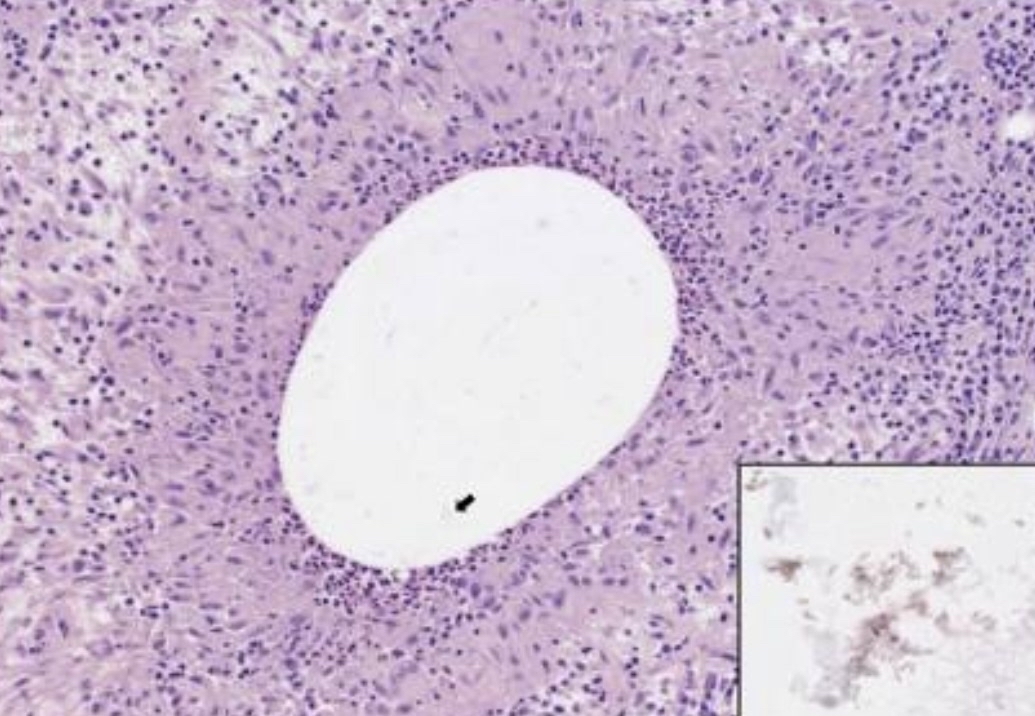 #MayoIDCase 37F recurrent left breast mastitis and abscess No response ...