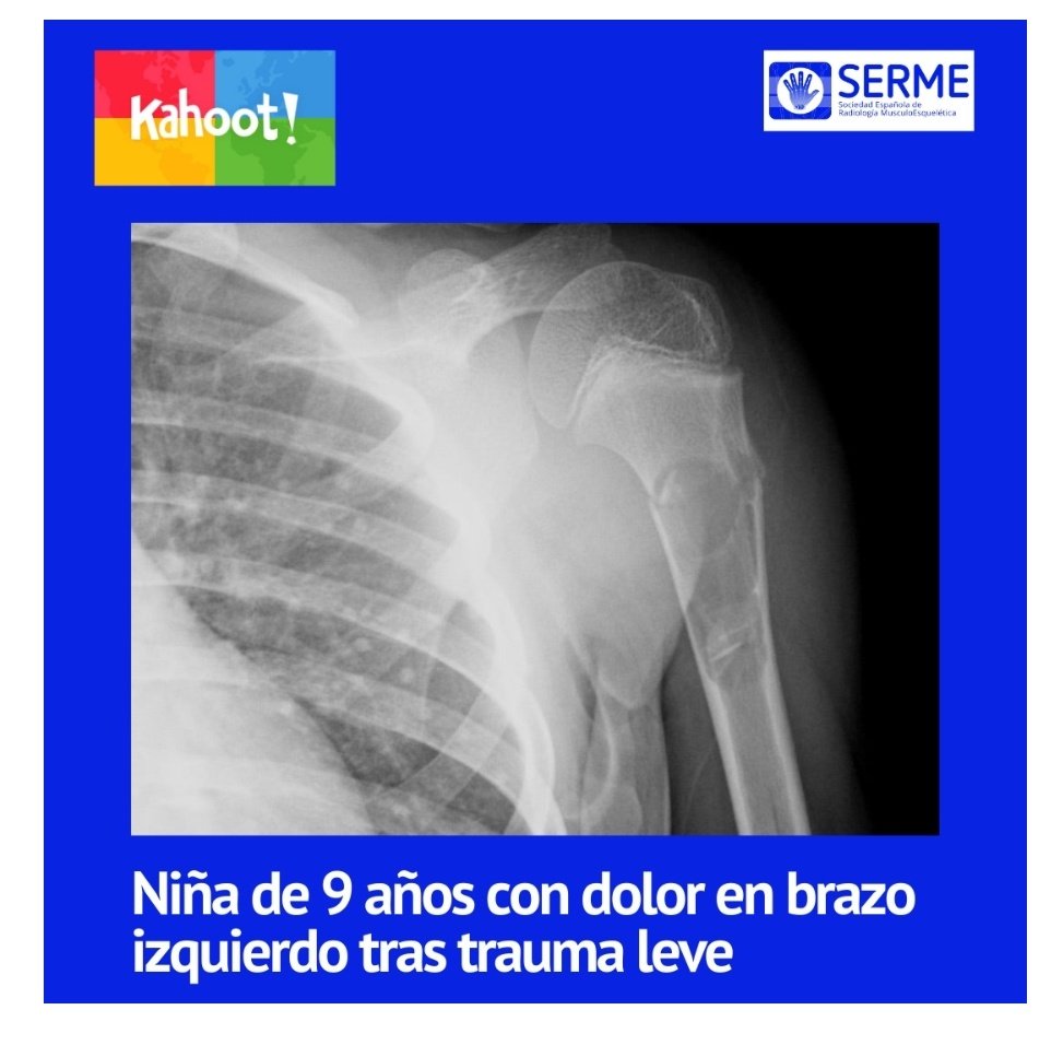 Hombro Normal De Rayos X