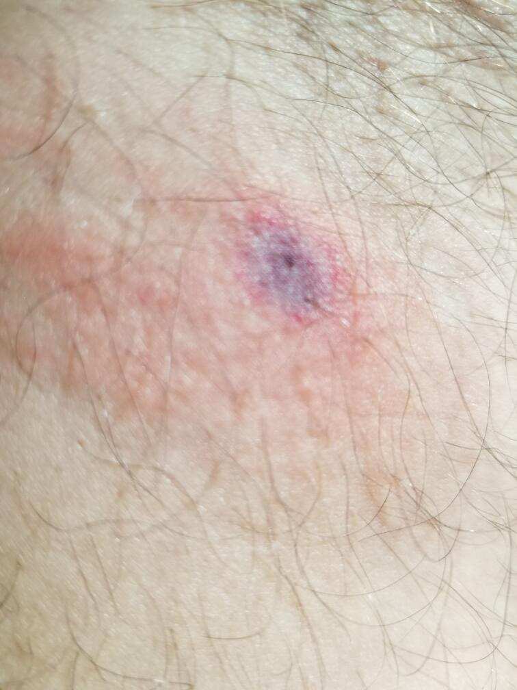 Red Bullseye Bite