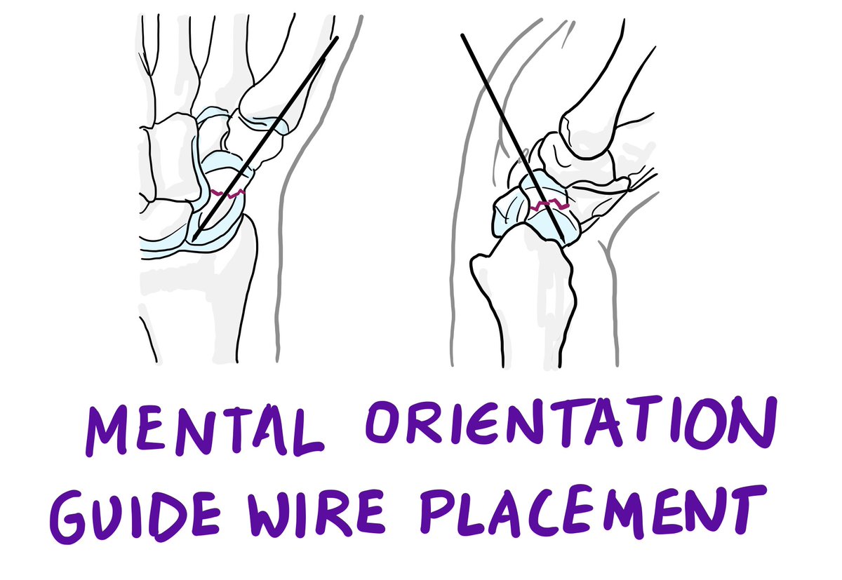For fresh DISTAL pole and WAIST scaphoid fractures, 90 % of them can be ...