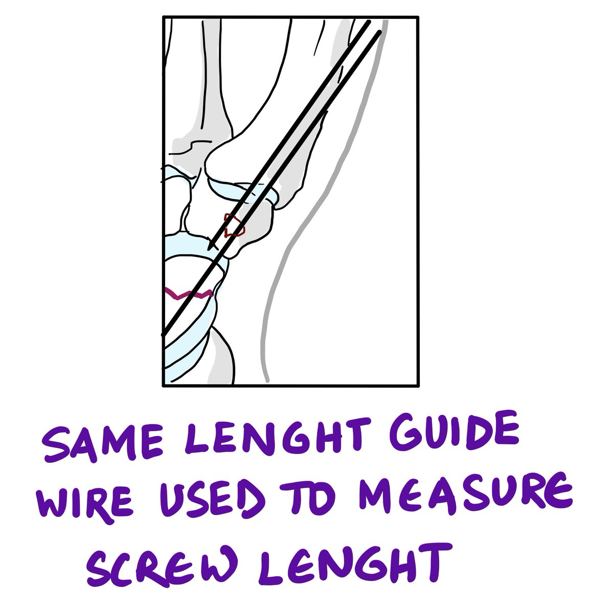 For fresh DISTAL pole and WAIST scaphoid fractures, 90 % of them can be ...