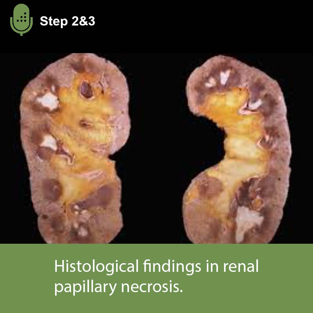 Renal Papillary Necrosis Histology Renal Papillary Necrosis: Video,