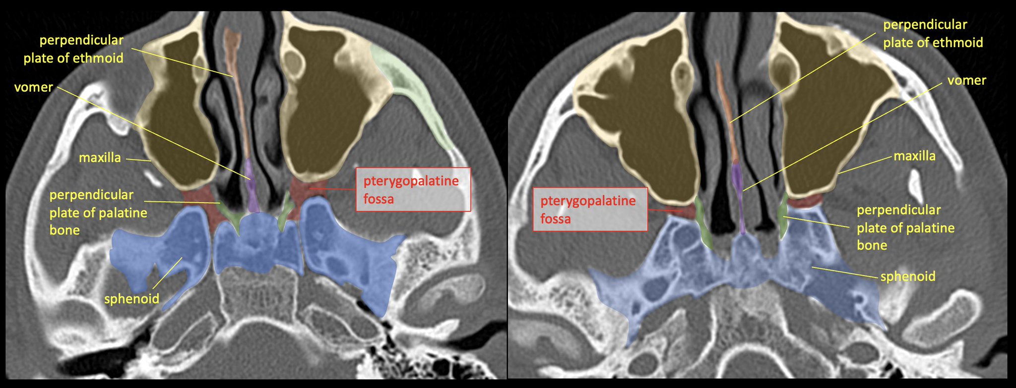 Pterygopalatine Fossa Sphenopalatine Foramen