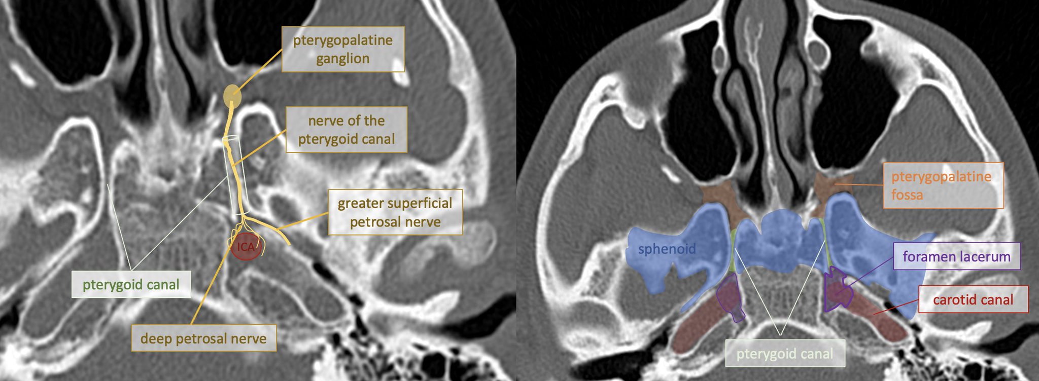 Pterygopalatine Canal