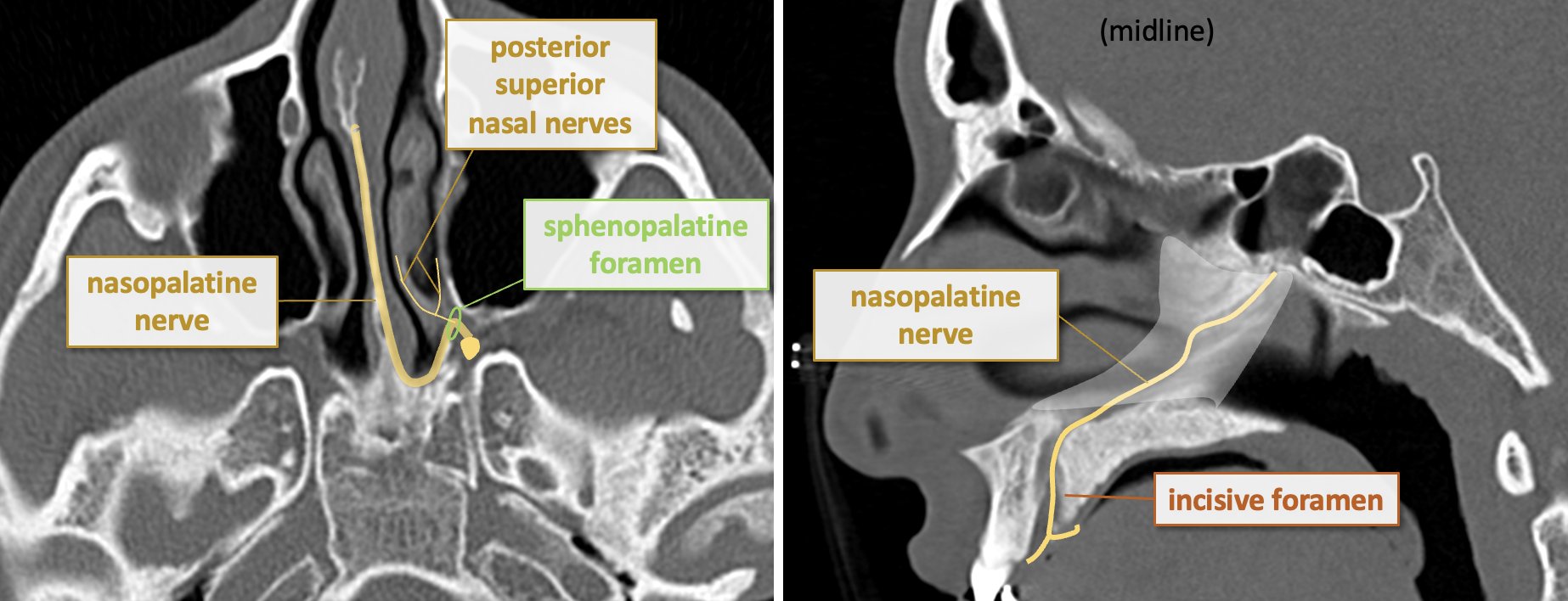 Nasopalatine Nerve Incisive