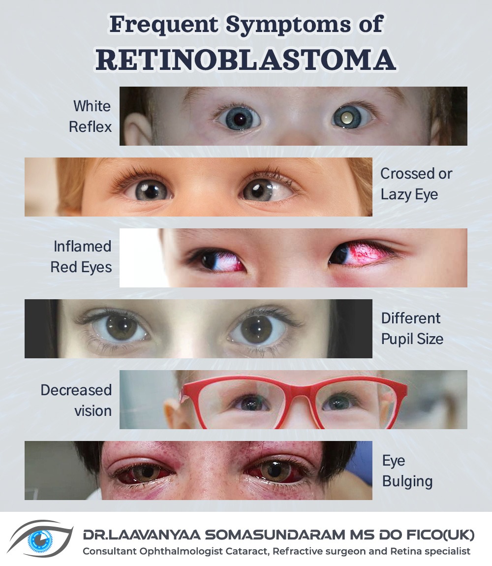 Retinoblastoma Symptoms
