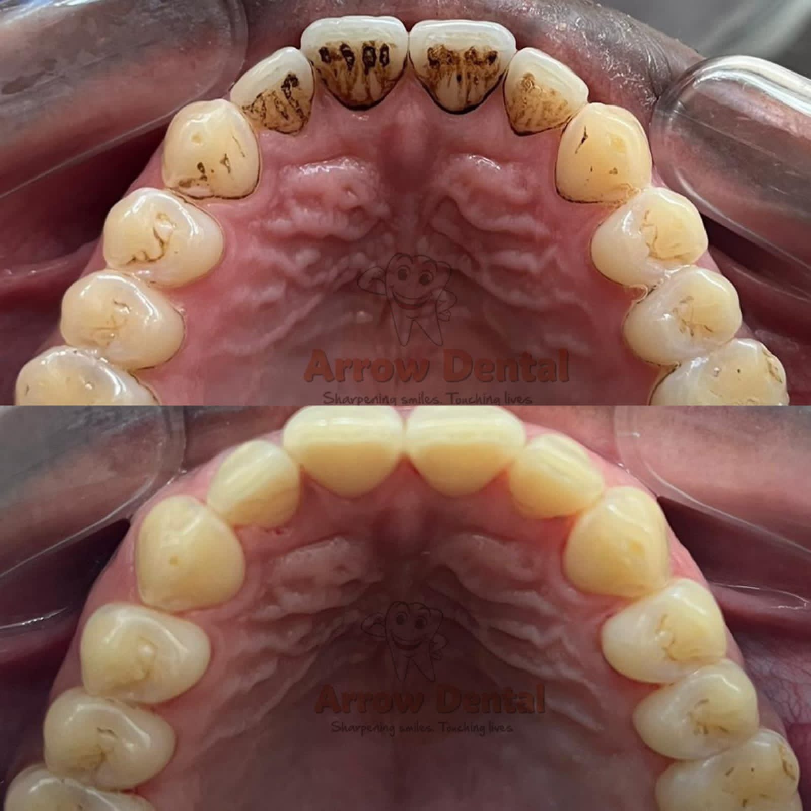 Fangs Teeth Sharpening