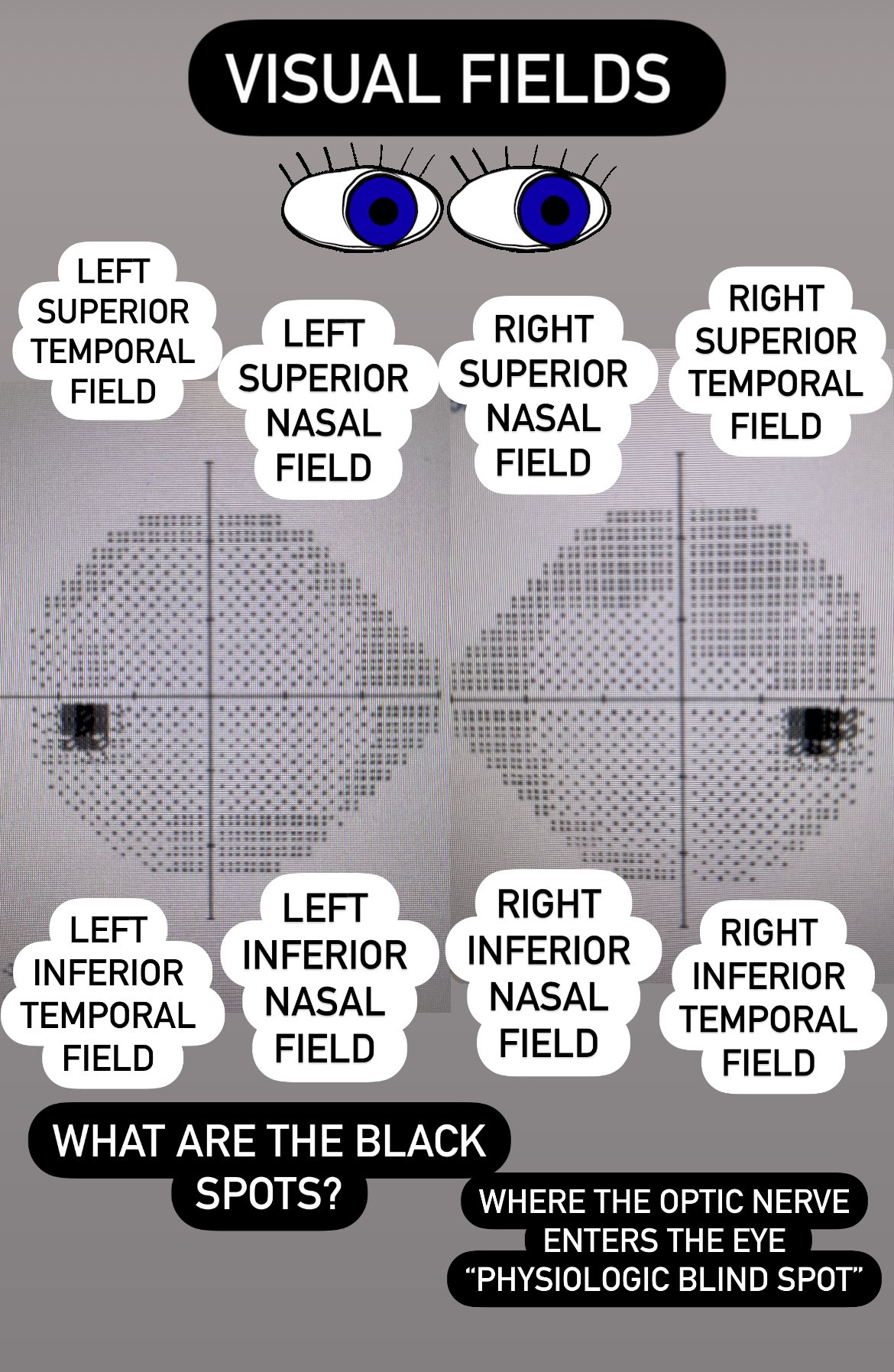 Which Is And Nasal Visual Field Interpretation
