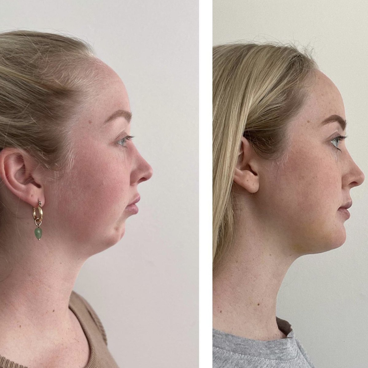 Underbite Surgery Swelling