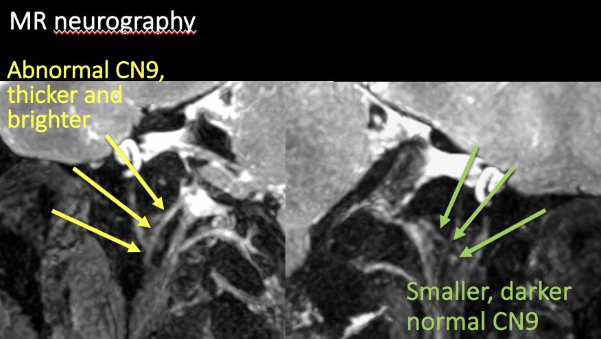 1/Pain doesn’t have a boundary Cranial nerve pain syndromes don’t stop at the skullbase ...