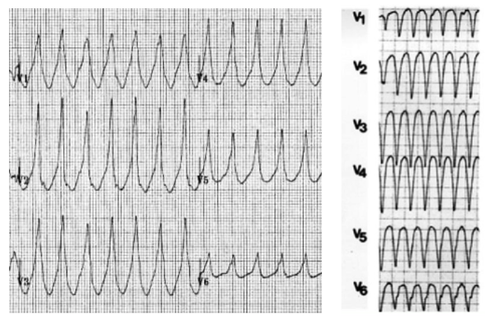 ‘VT’ versus ‘SVT with aberrancy’. The long list of VT "suggestive" ECG ...