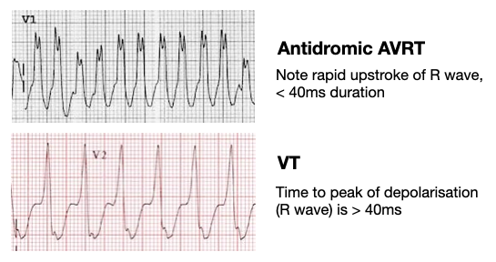 ‘VT’ versus ‘SVT with aberrancy’. The long list of VT "suggestive" ECG ...