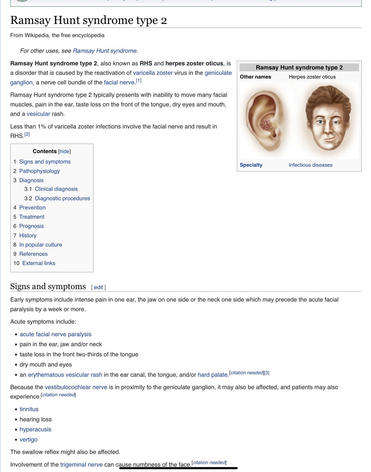 Shingles On Side Of Face Hot Sex Picture