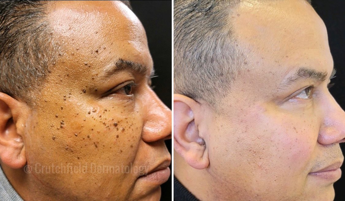 Dermatosis Papulosa Nigra Removal Before And After