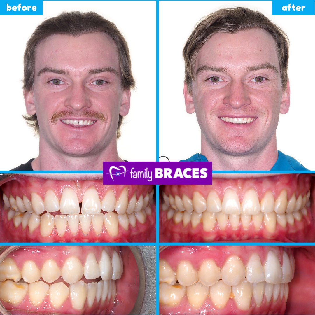 Invisalign Before And After Spacing