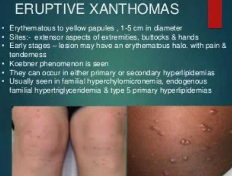 Tuberoeruptive Xanthoma