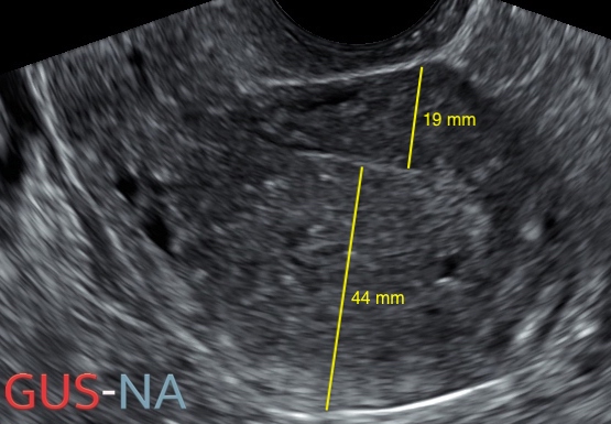 Adenomyosis Ultrasound
